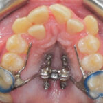 Maxillary Skeletal Expansion - Adventure Orthodontics